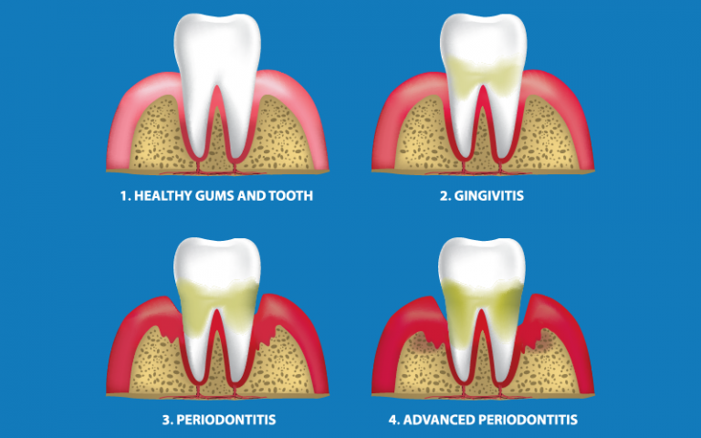 Gum Surgery Guide: Treatment, Cost & Recovery Explained